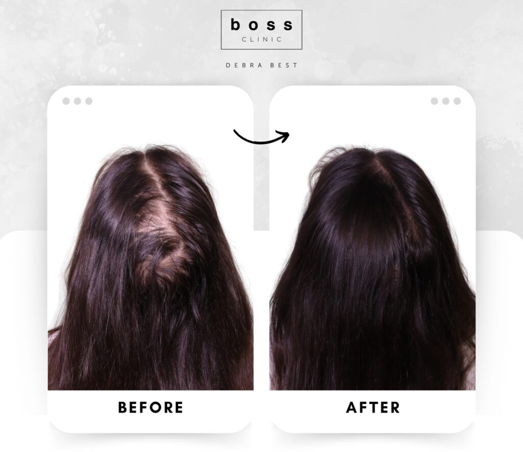 Womens Hair Loss Treatment Perth Boss Clinic 5178